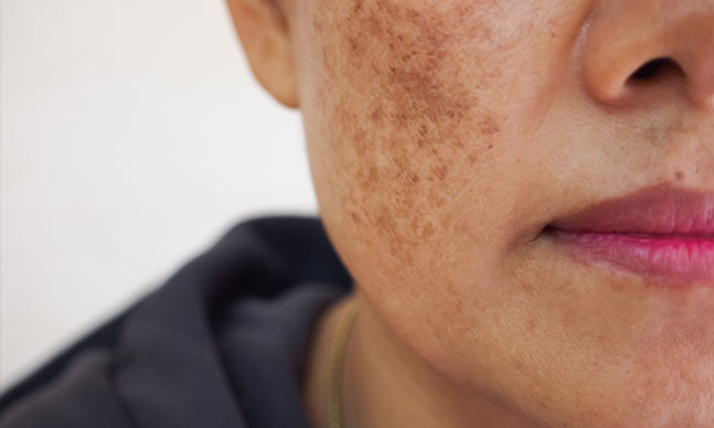 Melasma: o que são as manchas escuras na pele?
